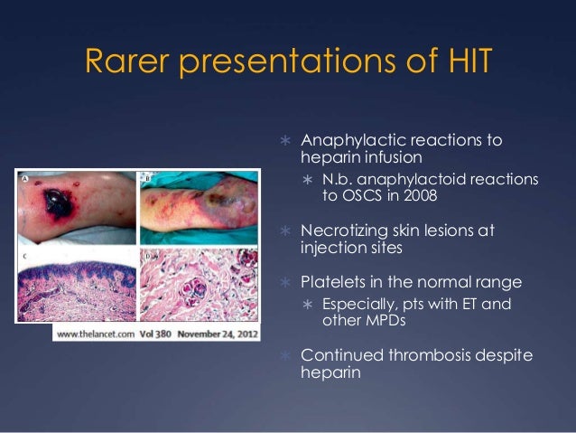 Heparin induced thrombocytopenia
