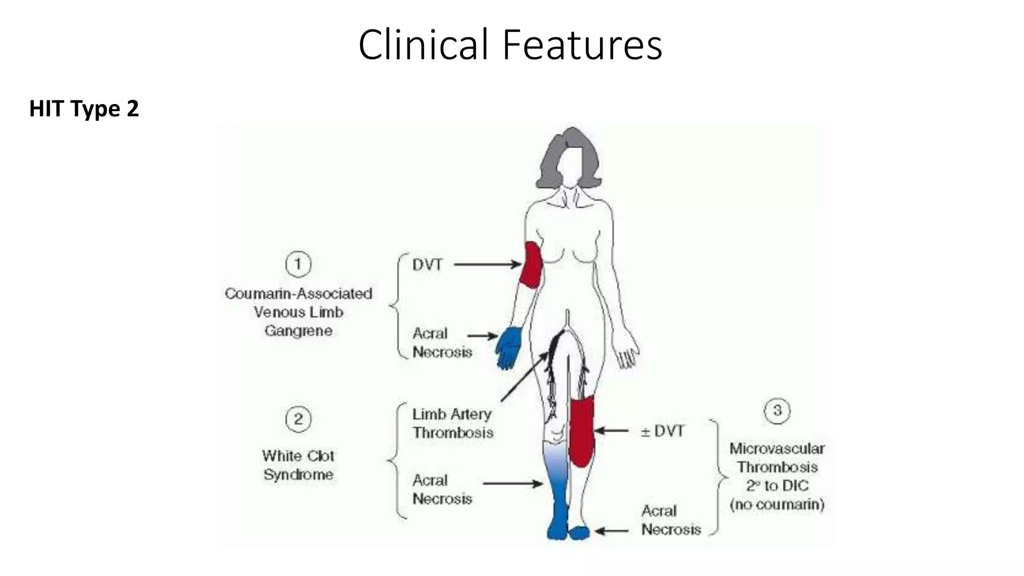 Heparin induced thrombocytopenia(hit) | PPTX