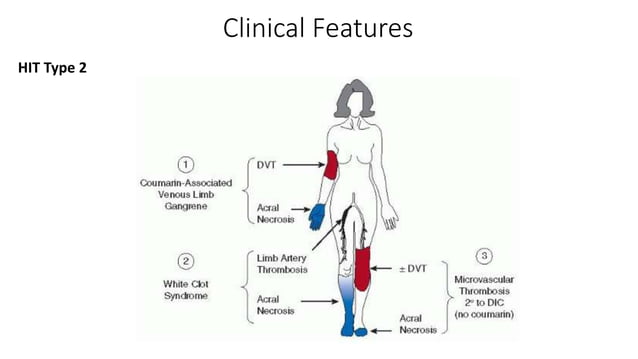 Heparin induced thrombocytopenia(hit) | PPTX
