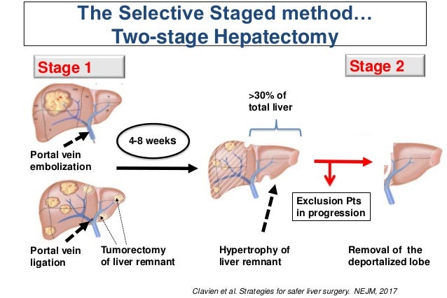 Hepatectomie en 2 temps - Pr René Adam