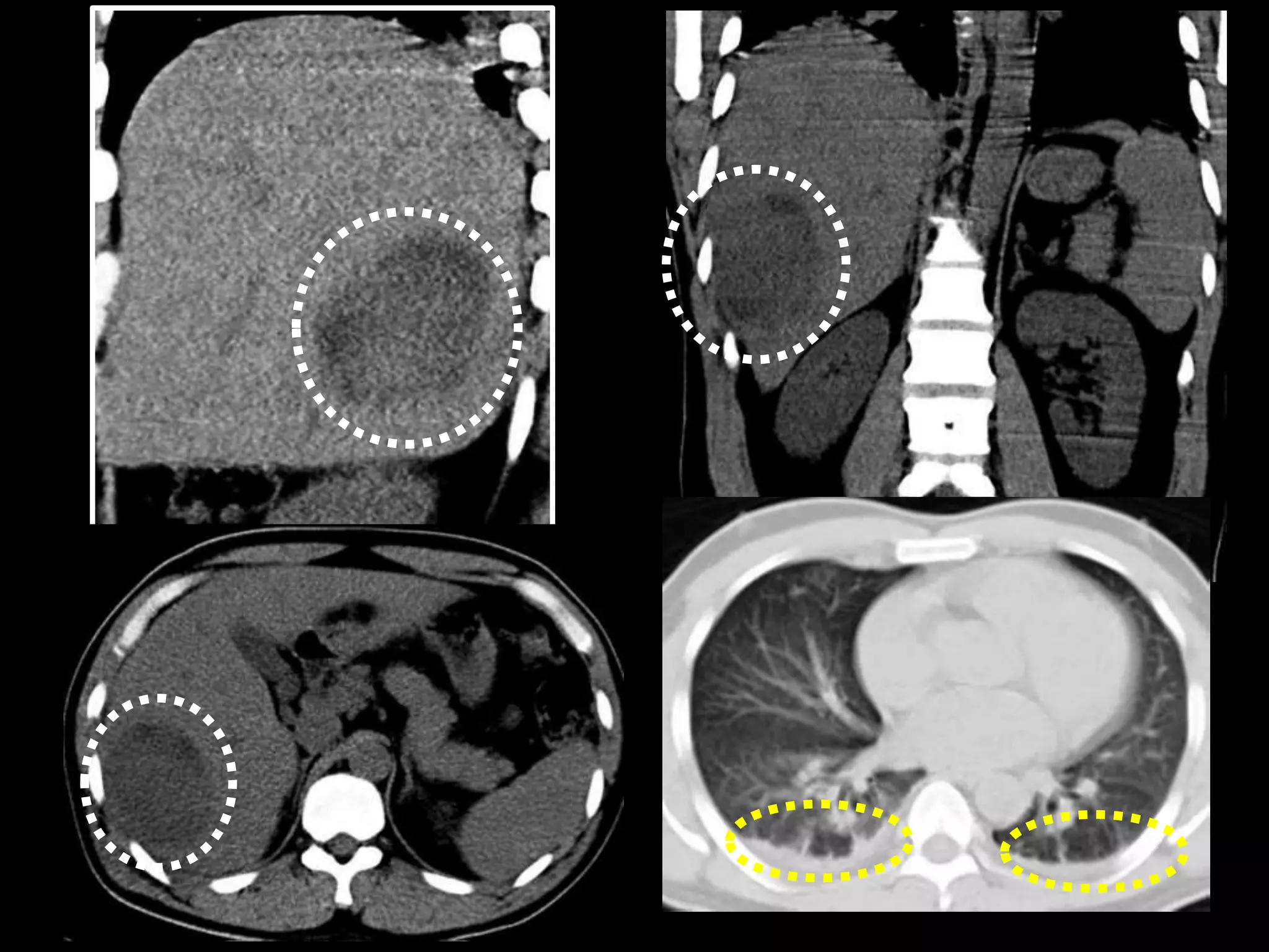 Hepatic abscess -Diagnostics | PPTX