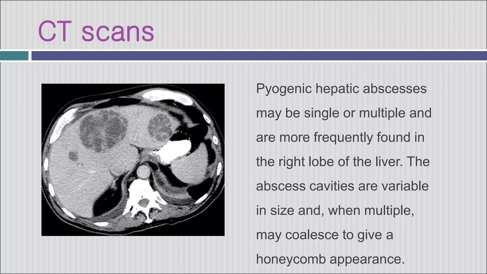 【中医药】Hepatic Abscess.ppt