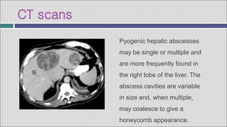 【中医药】Hepatic Abscess.ppt