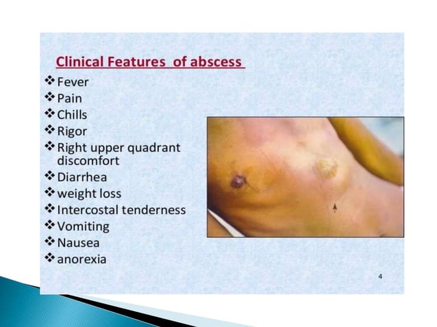 HEPATIC ABSCESSES liver problems ahn.pptx | Digestive Disorders | Diseases and Conditions