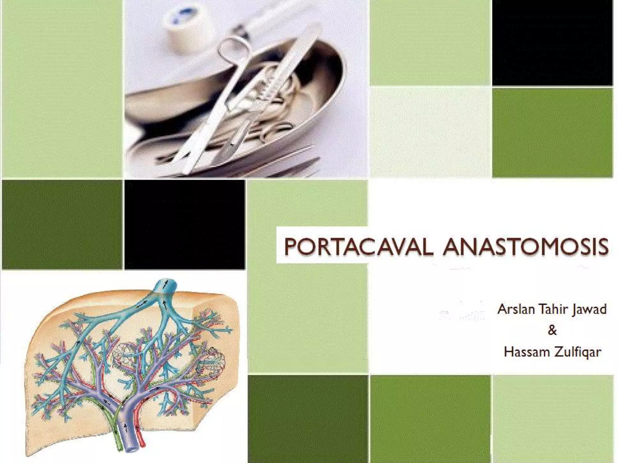 Portacaval Anastomosis | PPTX