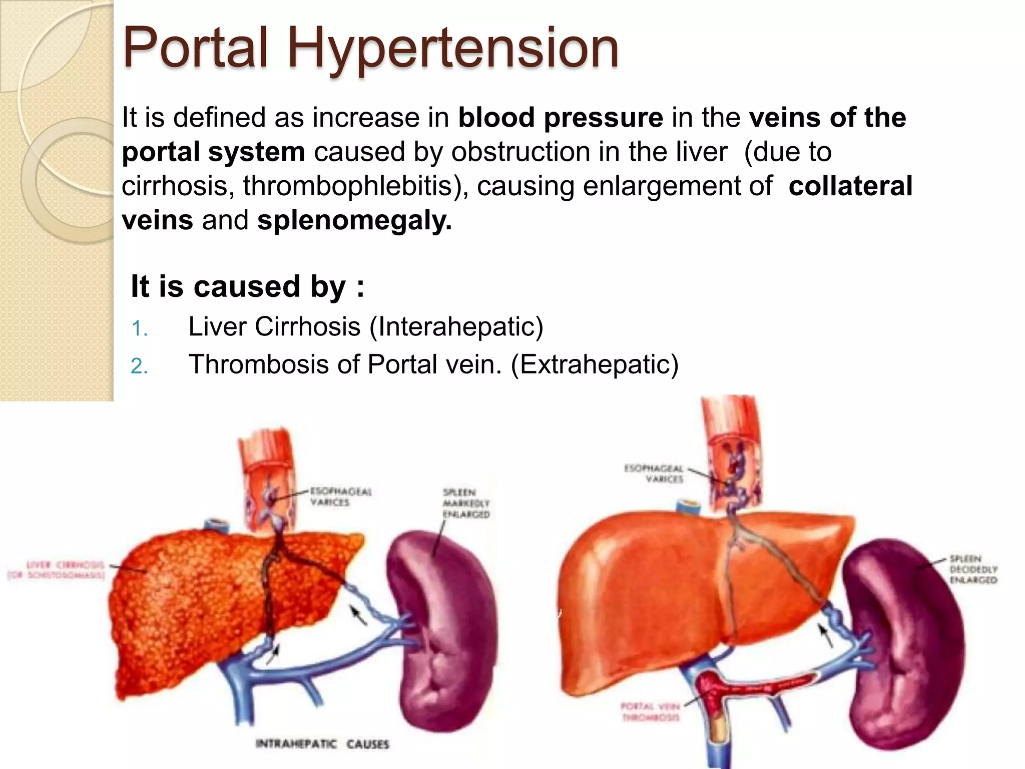 Portacaval Anastomosis | PPTX