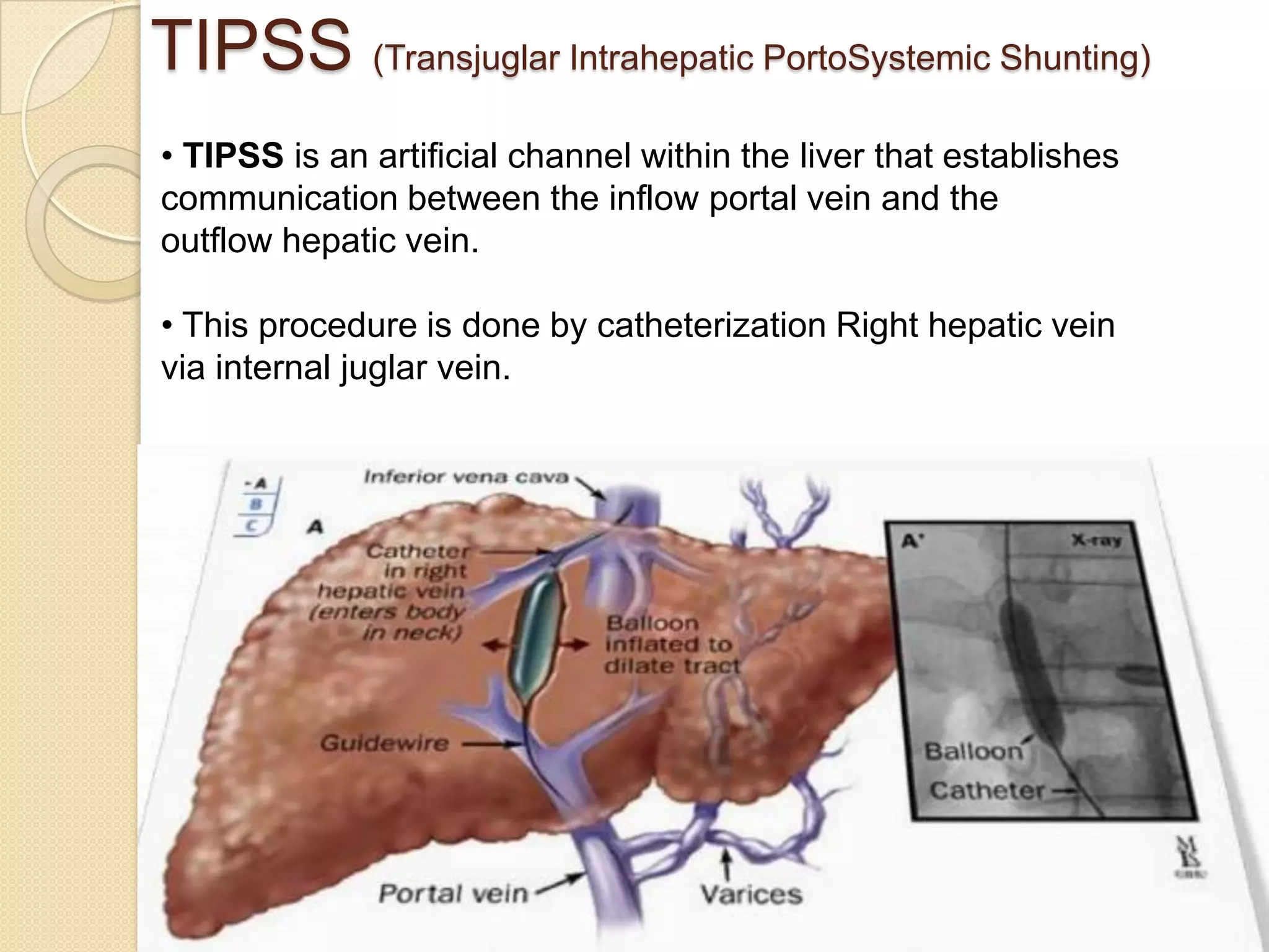 Portacaval Anastomosis | PPTX