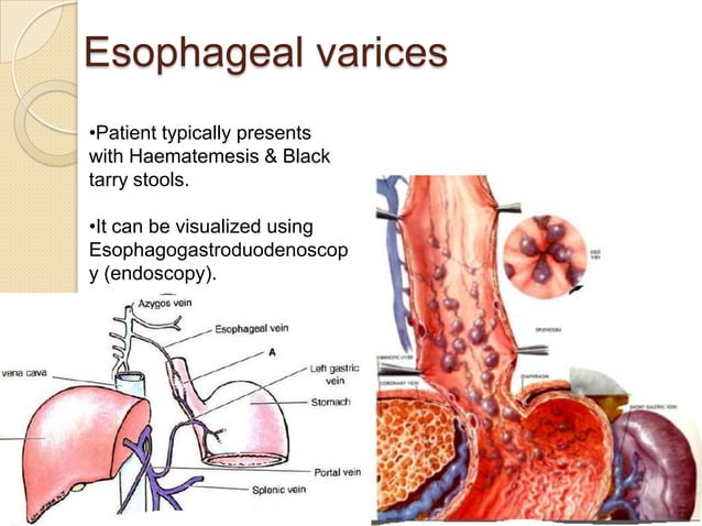 Portacaval Anastomosis | PPTX | Blood Disorders | Diseases and Conditions