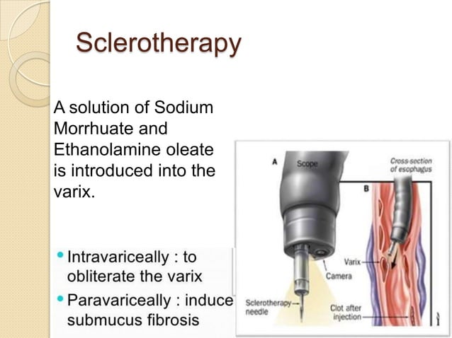 Portacaval Anastomosis | PPTX | Blood Disorders | Diseases and Conditions