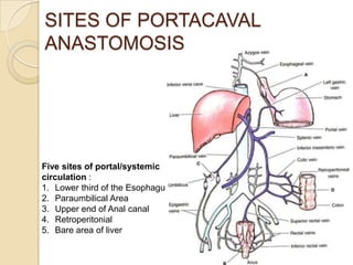 Portacaval Anastomosis | PPTX