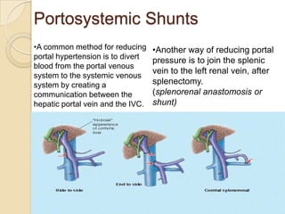 Portacaval Shunt