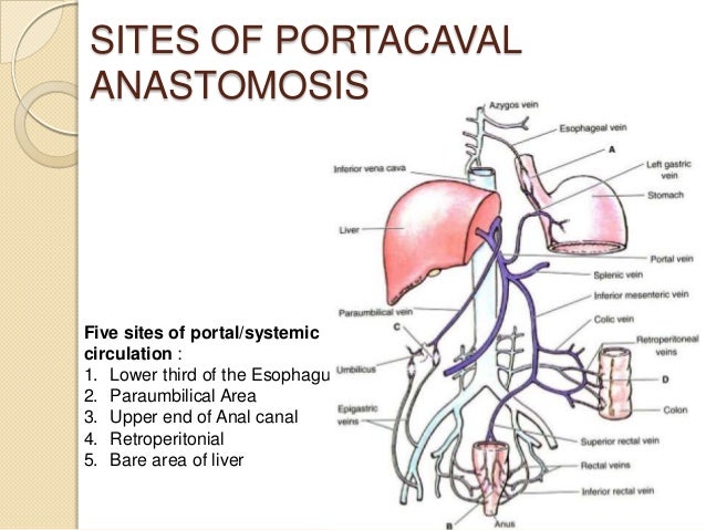 Portacaval Anastomosis