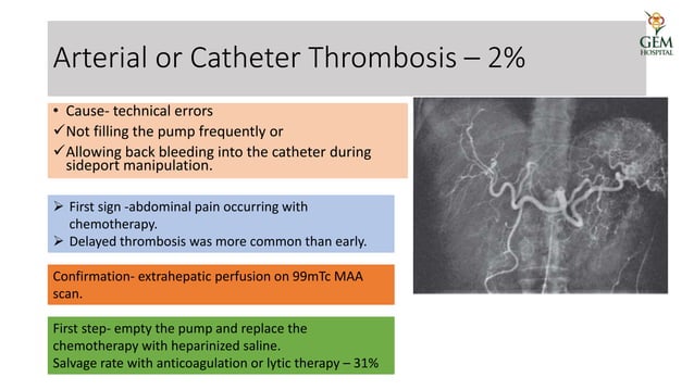 HEPATIC ARTERIAL INFUSION PUMP CHEMOTHERAPY IN HCC AND IHCC.pptx