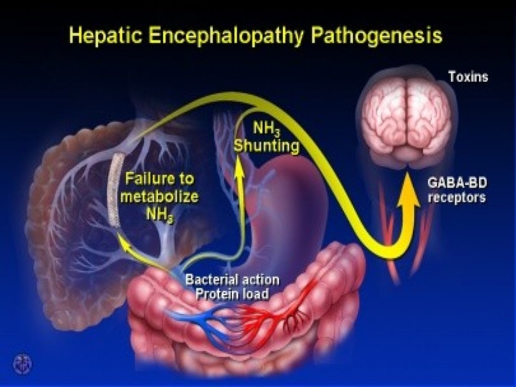 Hepatic encephalopathy, short review & update