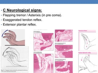 Hepatic encephalopathy | PPTX