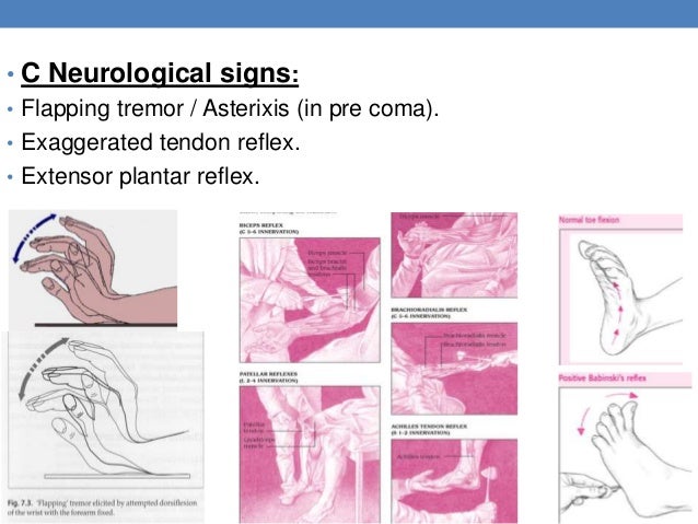 Hepatic encephalopathy