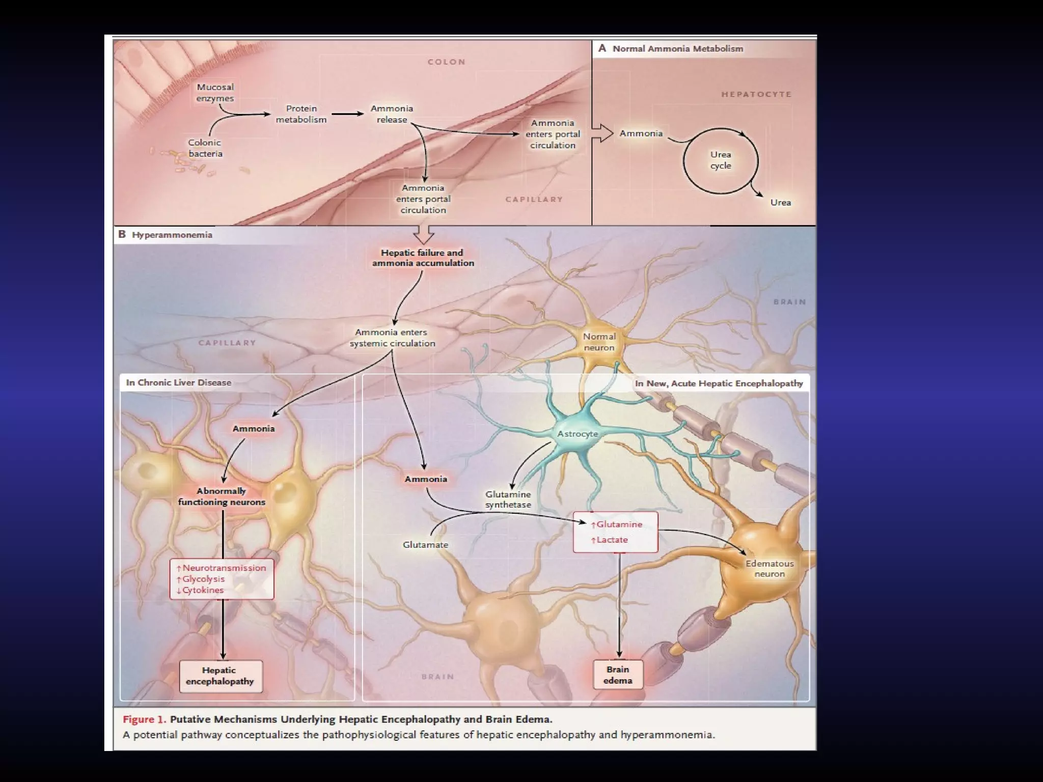 Hepatic Encephalopathy -Pathophysiology,Evaluation And Management | PPT