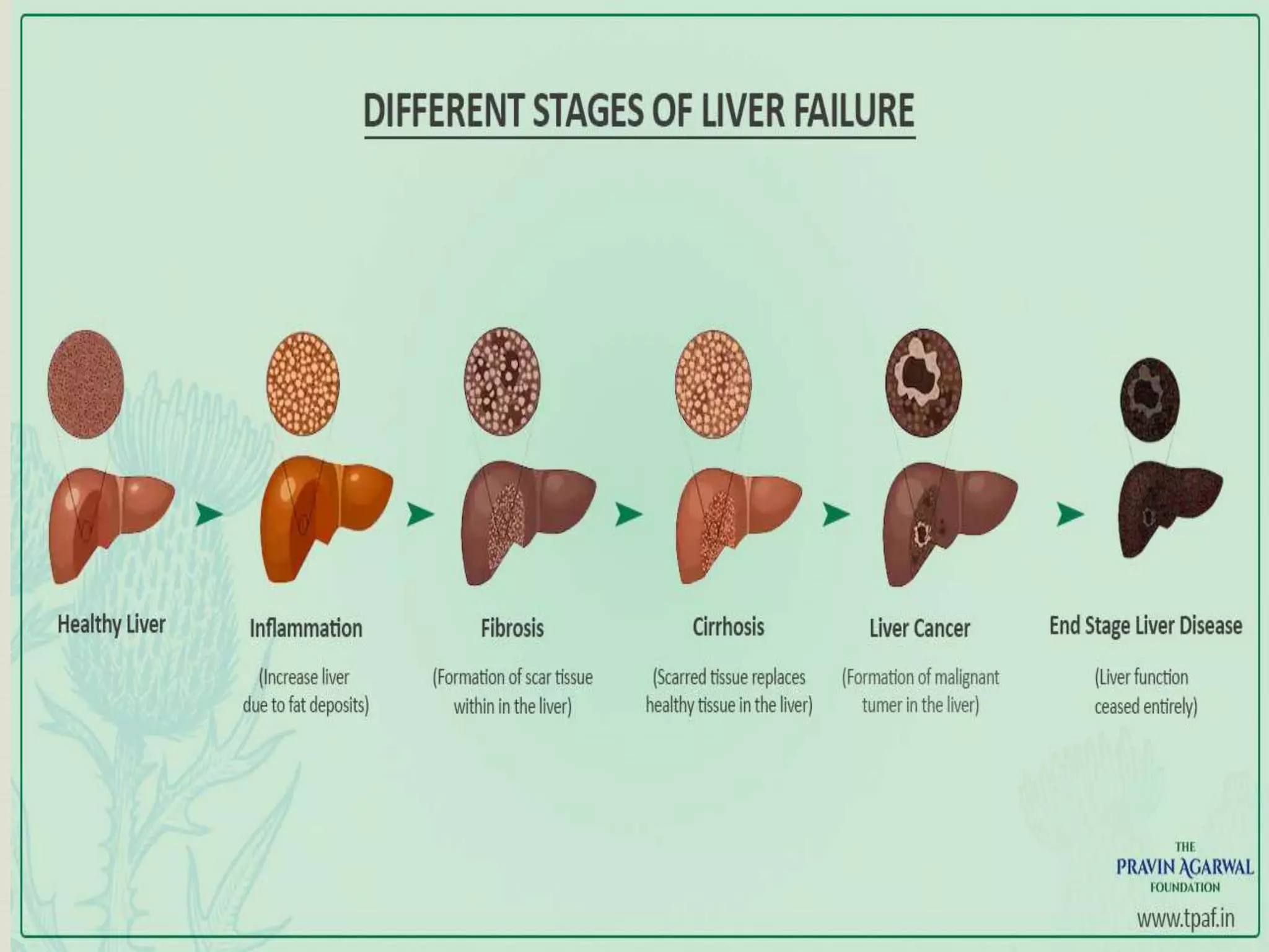 Hepatic Failure.pptx