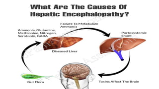 hepatic failure.pptx hepatic encephalopathy | PPT