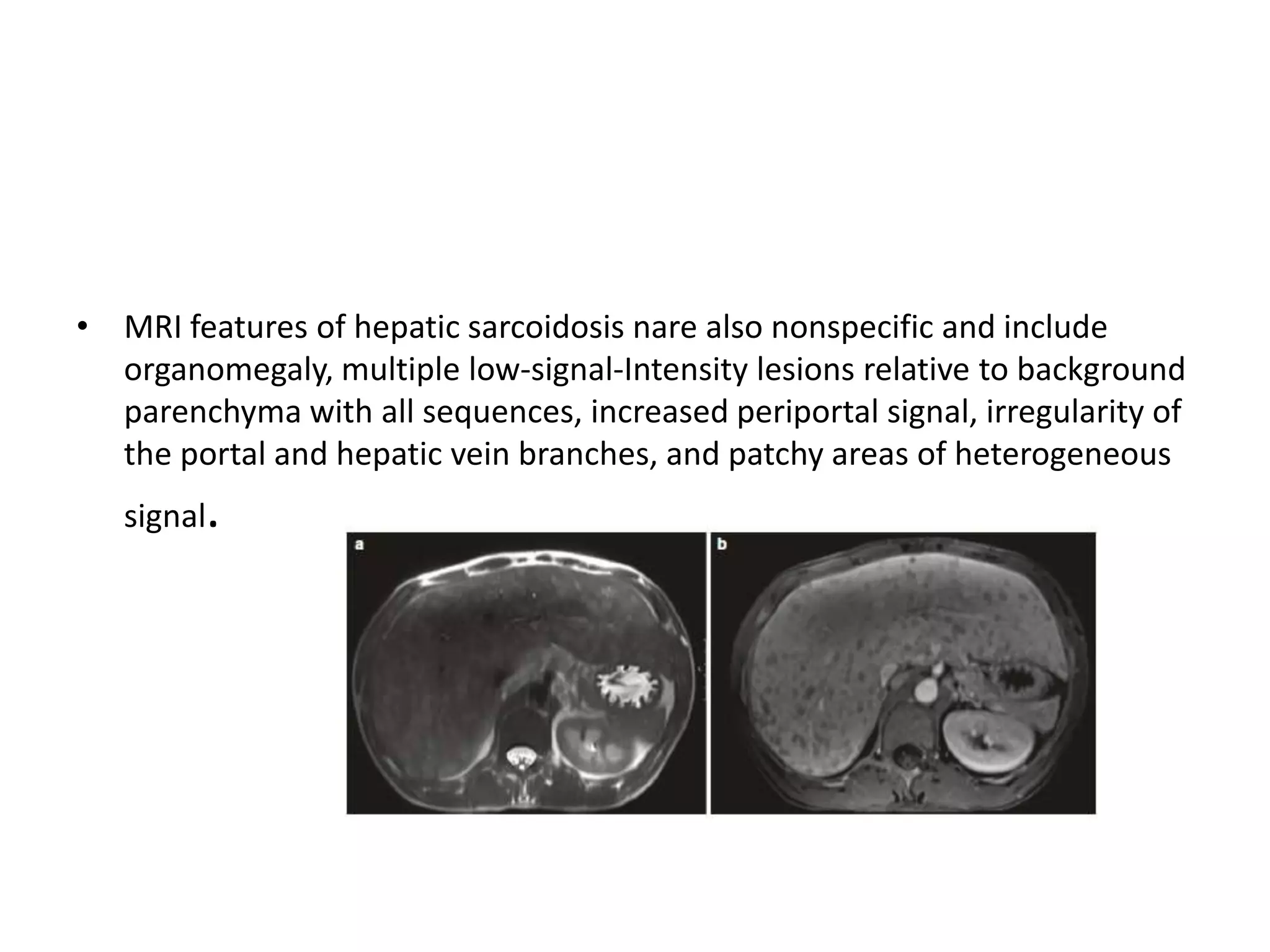 hepatic infections and inflammatory lesions VP (1).pptx