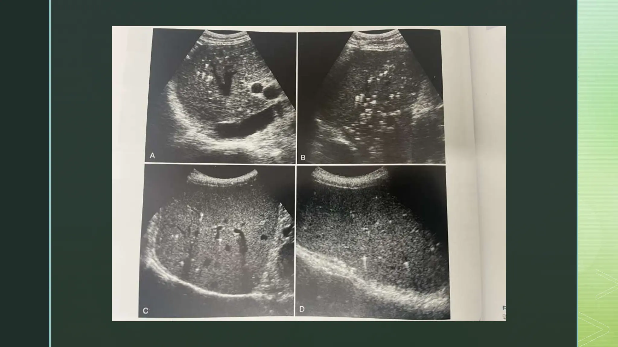 USG,CT AND MR IMAGING OF HEPATIC MASS LESIONS. | PPT