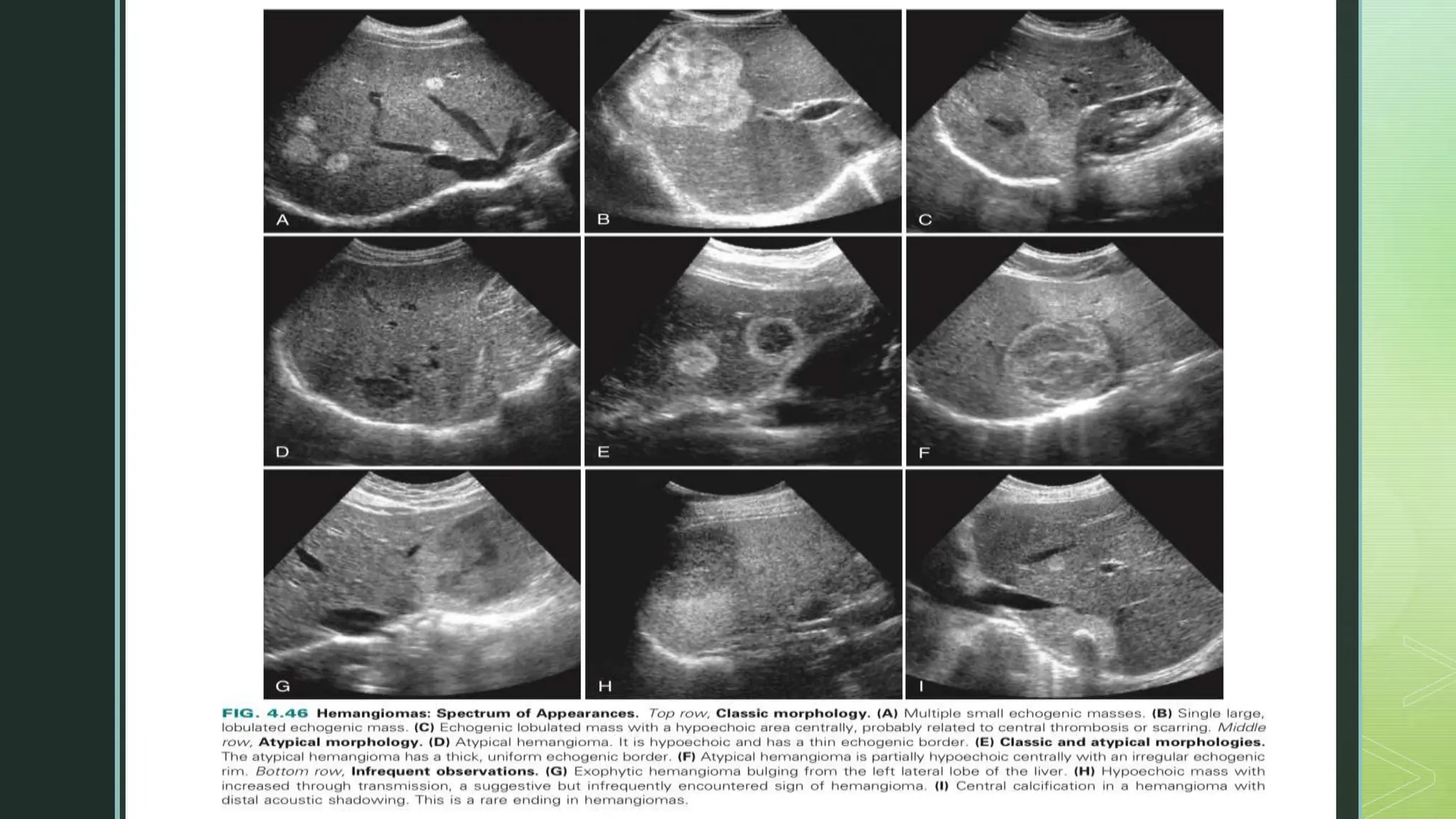 USG,CT AND MR IMAGING OF HEPATIC MASS LESIONS. | PPT