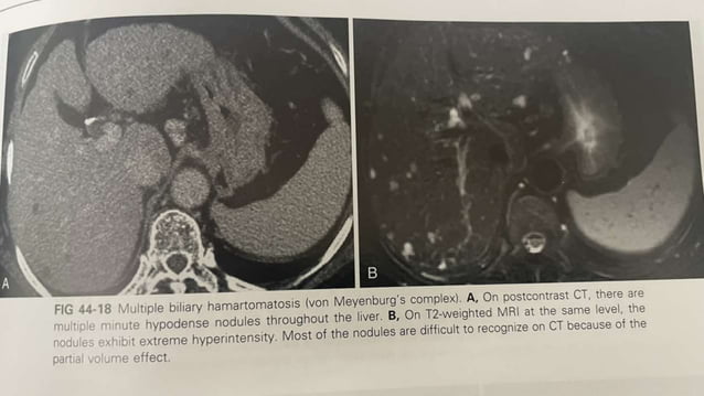 USG,CT AND MR IMAGING OF HEPATIC MASS LESIONS. | PPT