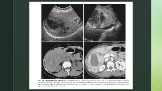 USG,CT AND MR IMAGING OF HEPATIC MASS LESIONS. | PPT