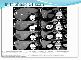 Hepatic peliosis | PPT