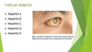 Hepatitis | PPTX | Infectious Diseases | Diseases and Conditions