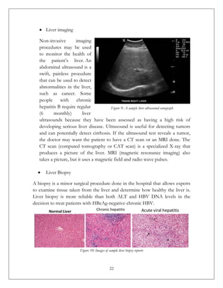 Hepatitis-B: A Case Study | PDF