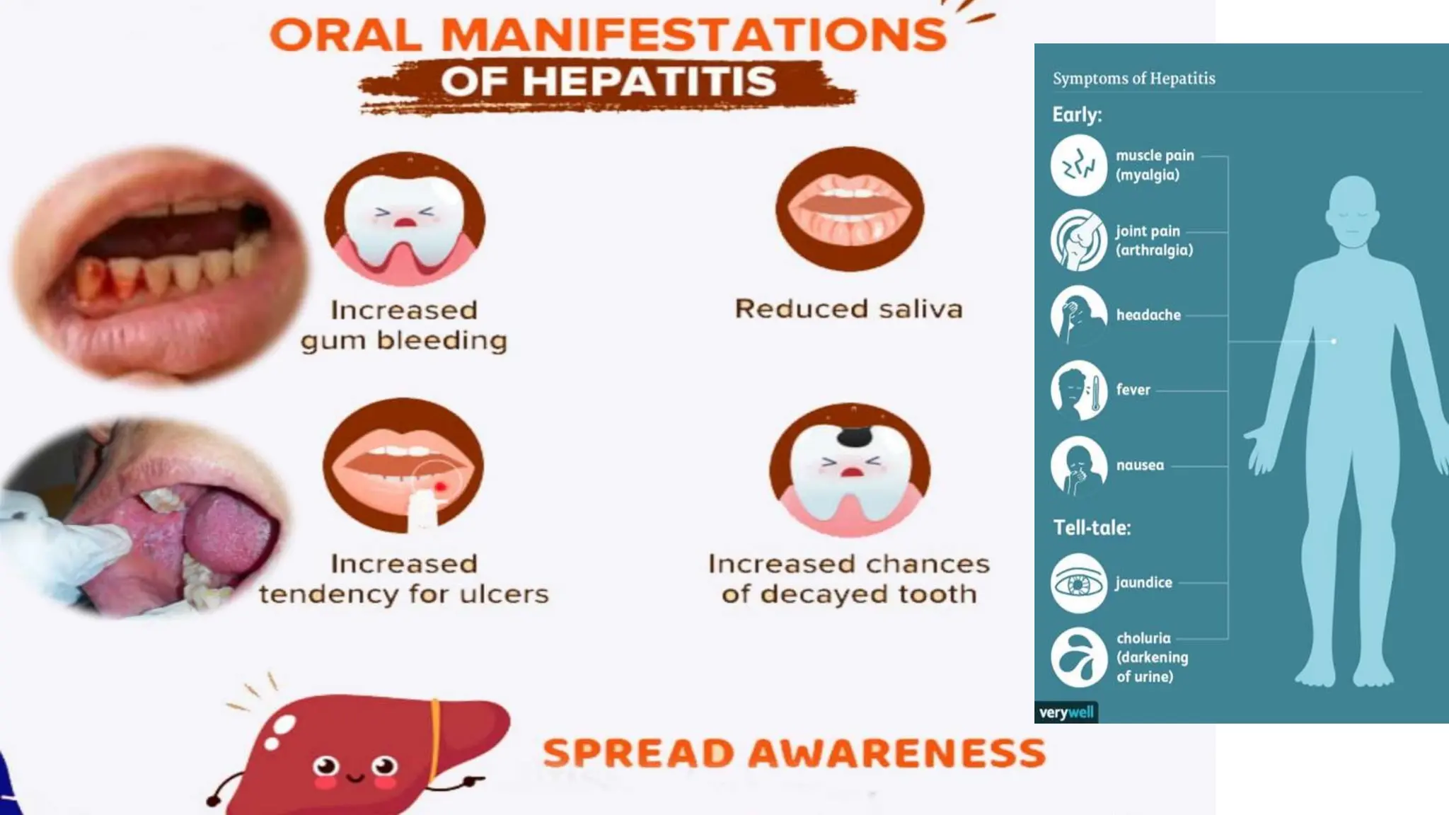 Hepatitis is inflammation of the liver. It can be caused by viruses ...