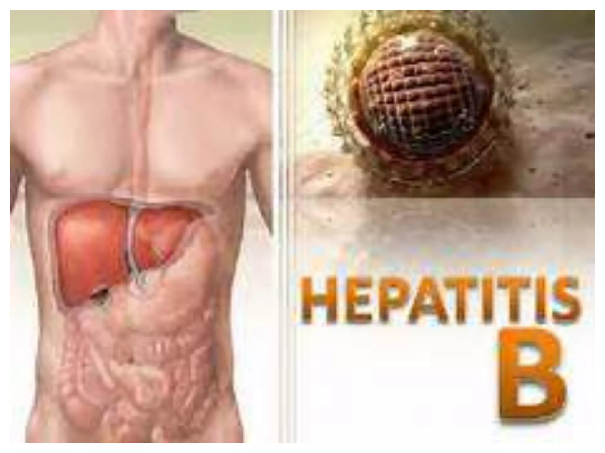 Hepatitis b | PPTX