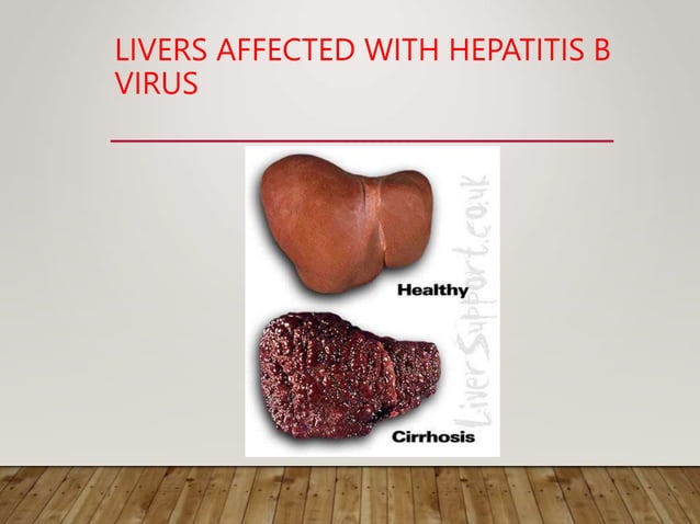 HEPATITIS_B_presentation disease control and management.ppt