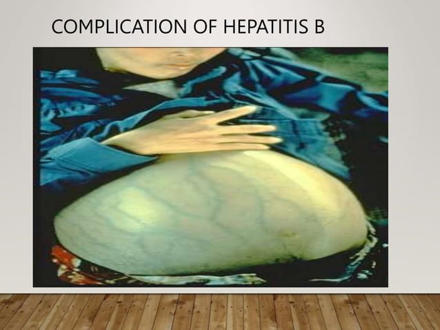 HEPATITIS_B_presentation disease control and management.ppt