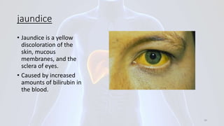 Hepatitis B Patient Eyes
