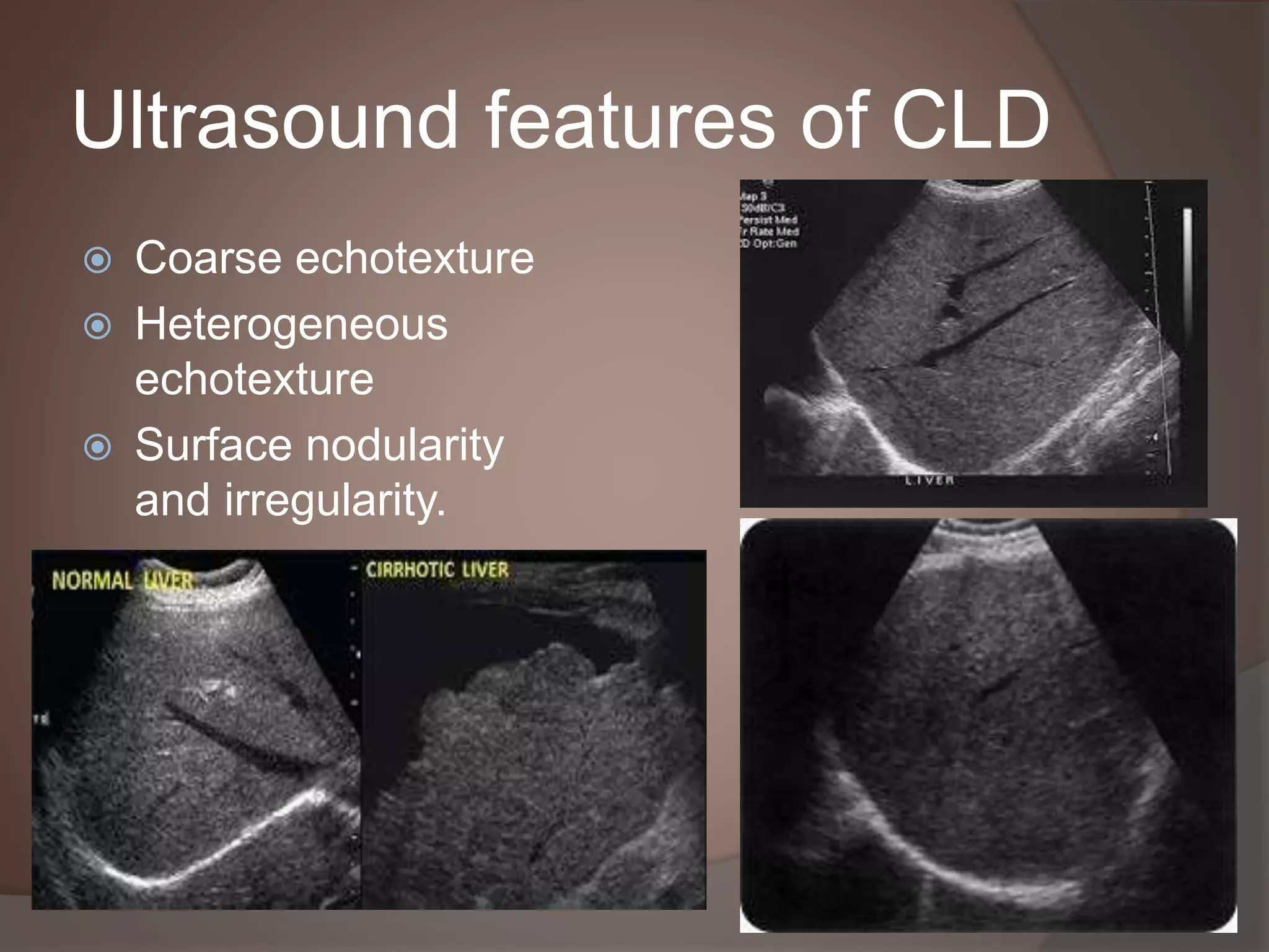 Acute Chronic Hepatitis Sonology Urdu | PPTX