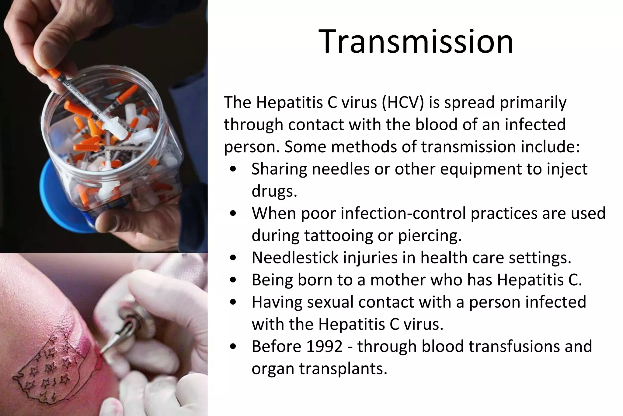 Hepatitis c | PPTX
