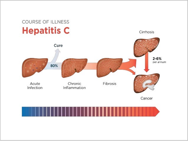 Hepatitis c infection, causes, treatment, and prevention