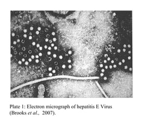 Hepatitis e virus infection | PPT