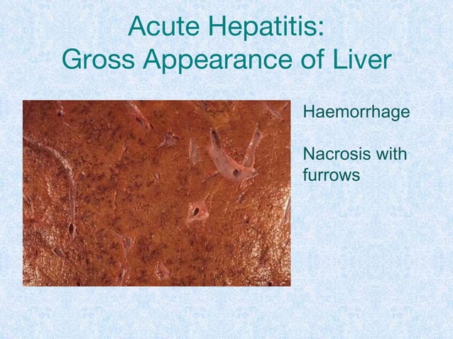 Hepatitis Acute versus Chronic Causes Pathophysiology.pdf