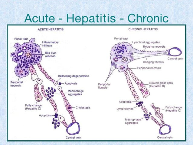 Hepatitis Acute versus Chronic Causes Pathophysiology.pdf