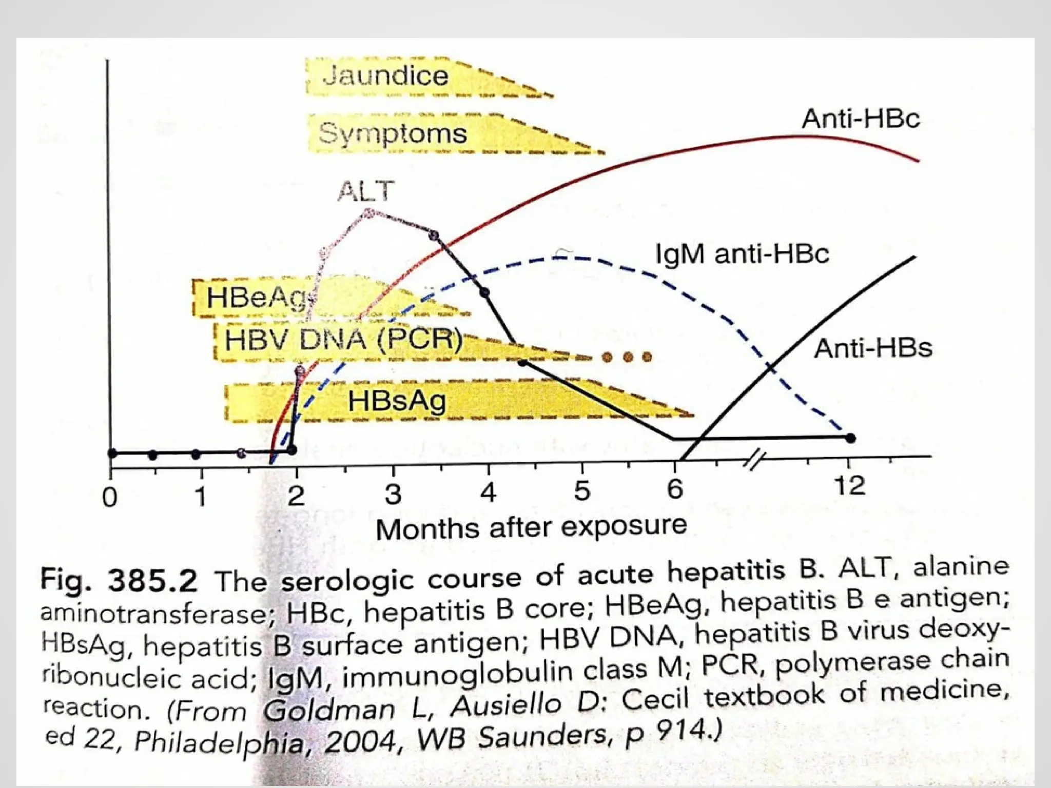 hepatitis ppt includes hepatitis in children- pathophysiology, signs ...