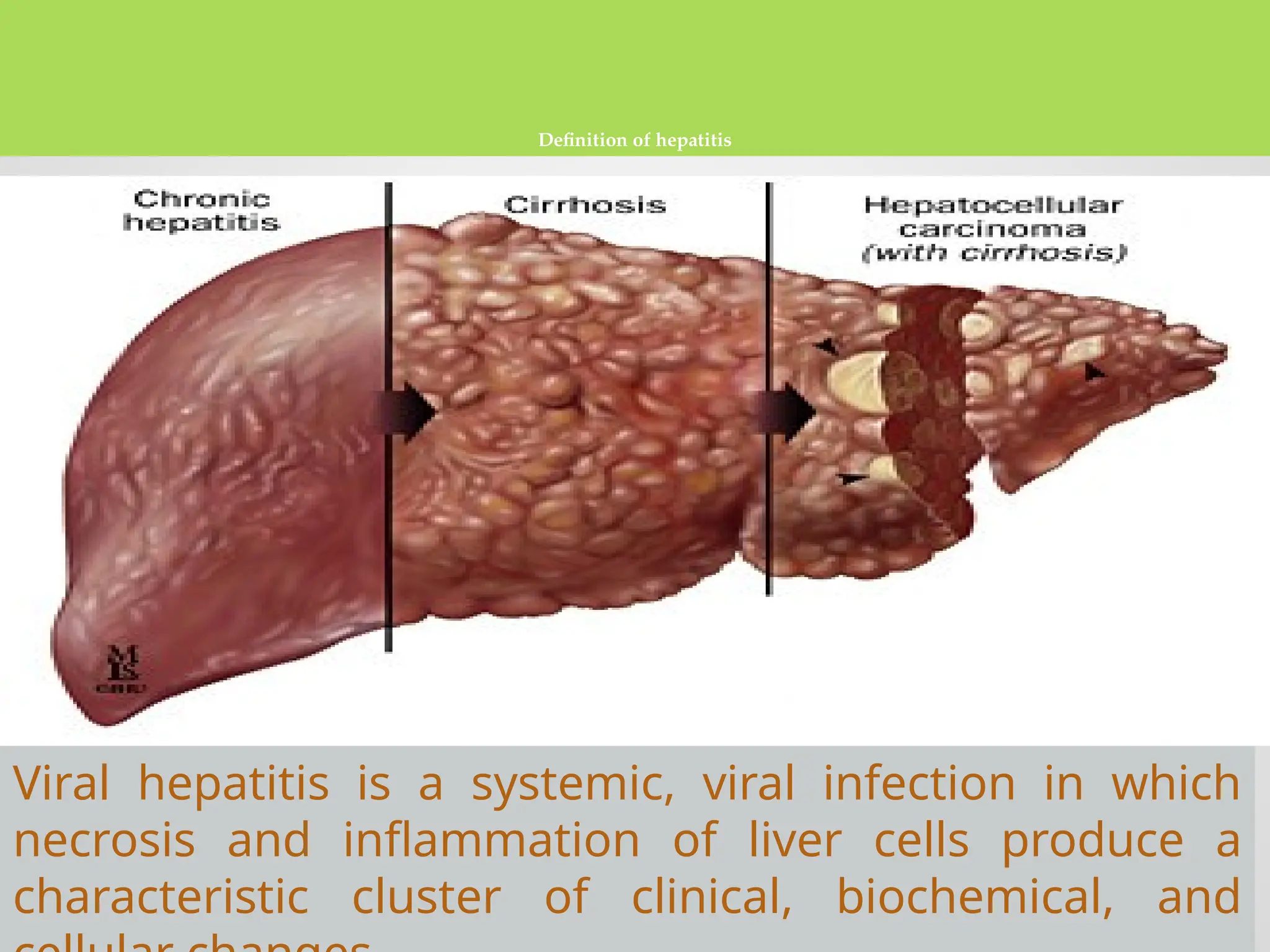 hepatitis ppt includes hepatitis in children- pathophysiology, signs ...