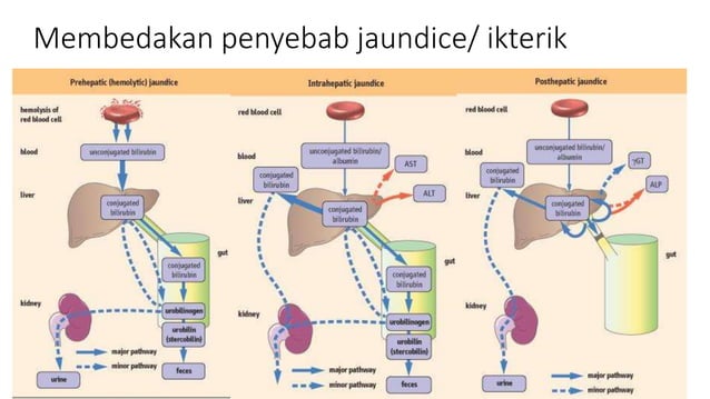 Hepatitis, sirosis hepatis, fatty liver.pptx