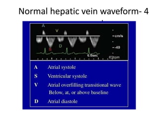 Hepato Portal Doppler Ultrasound Pptx