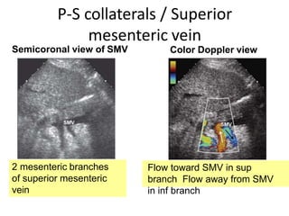 Hepato portal doppler ultrasound | PPTX