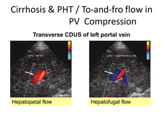 Ultrasound Hepatopetal Flow