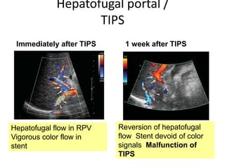 Ultrasound Hepatopetal Flow