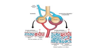 HEPATO-RENAL SYNDROME , HEPATO-PULMONARY SYNDROME & PORTAL HYPERTENSION ...